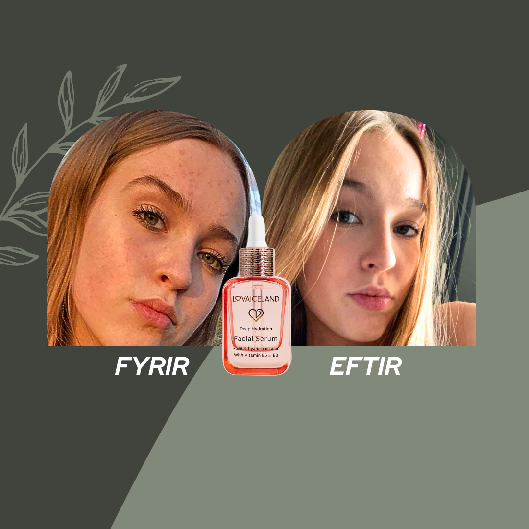 Það besta sem hefur virkað á bólurnar – LovaIceland